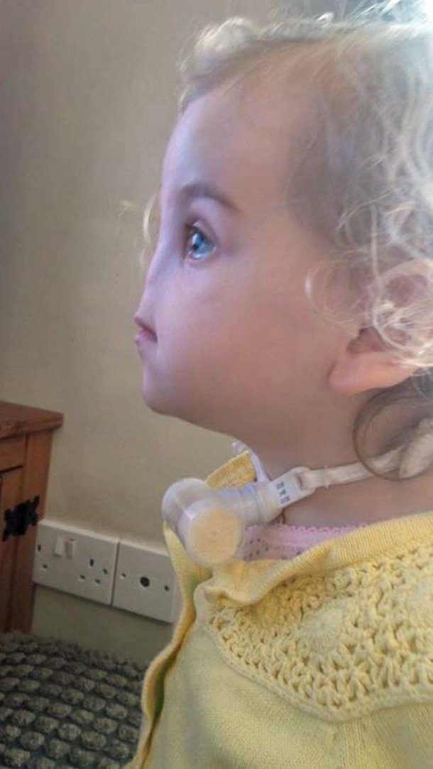 Acredite Menina Que Nasceu Sem Nariz Terá Prótese Feita Por Impressora